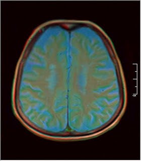 Nevit's blog: False-color Brain MRI (Motion artifacts)