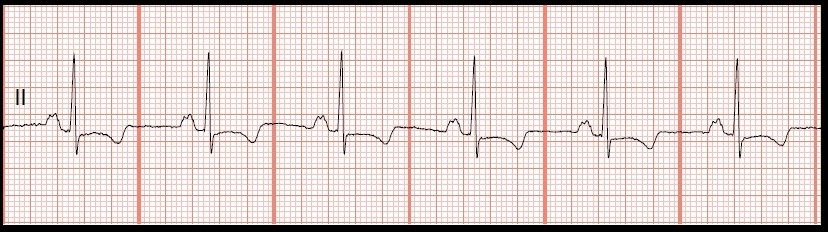 Float Nurse: EKG Rhythm Strip Quiz 161