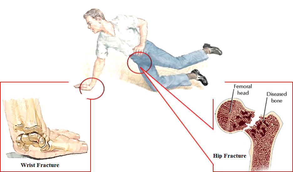 Fitnesspedia: Preventing Falls in Senior Citizens