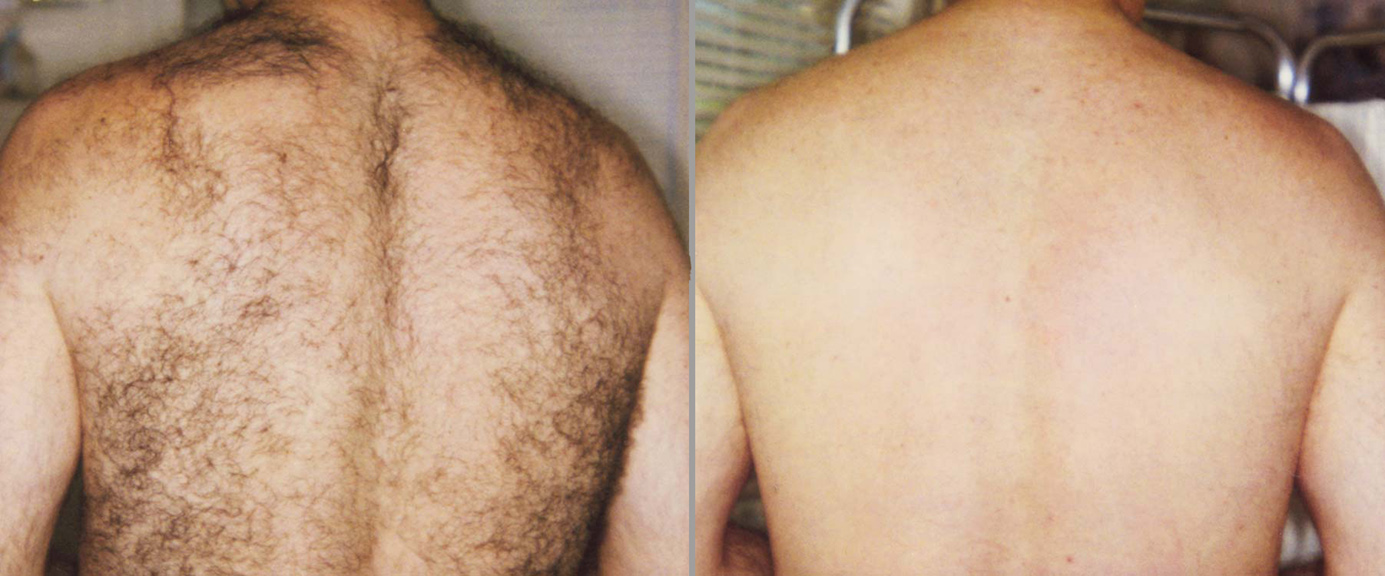Comment faire pour supprimer Barbe en permanence ~ Comment Fait Comment faire pour supprimer Barbe en permanence ~ Comment Fait