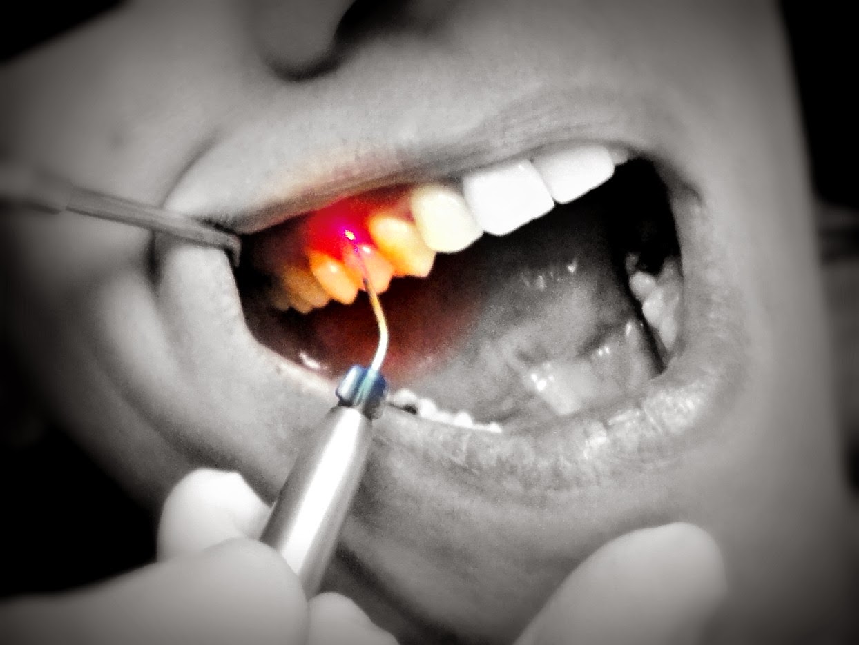 #Tubuleslive Event: Laser Periodontics - Where a Scaler and Blade Just ...