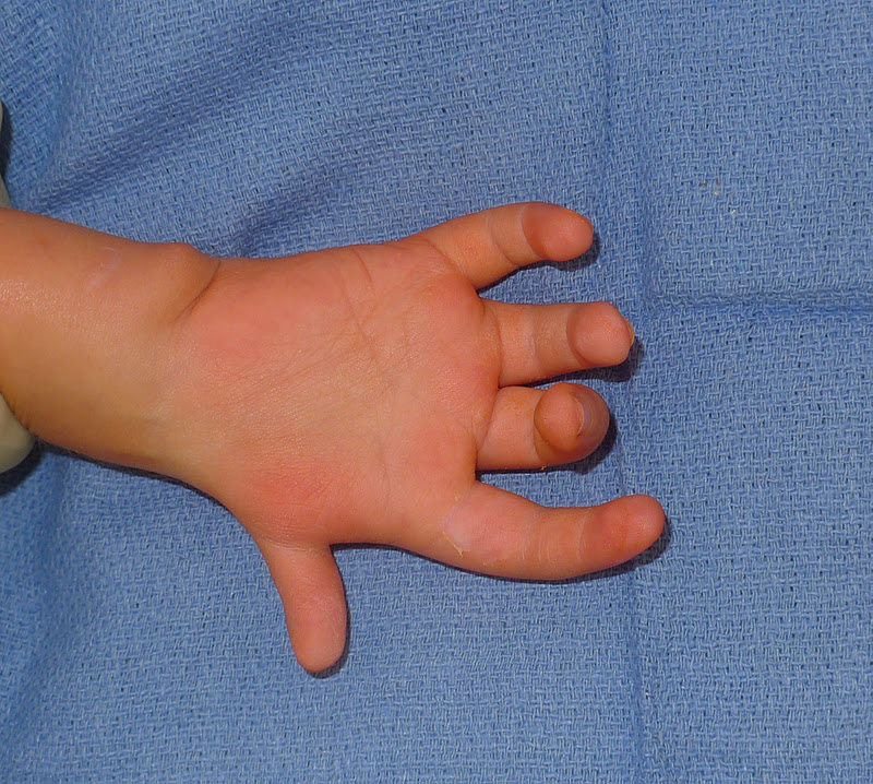 More thoughts on Pollicization | Congenital Hand and Arm Differences ...