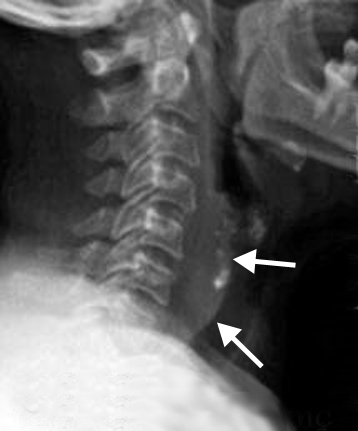 ENT for medical students: ENT PICTURES - PHARYNX