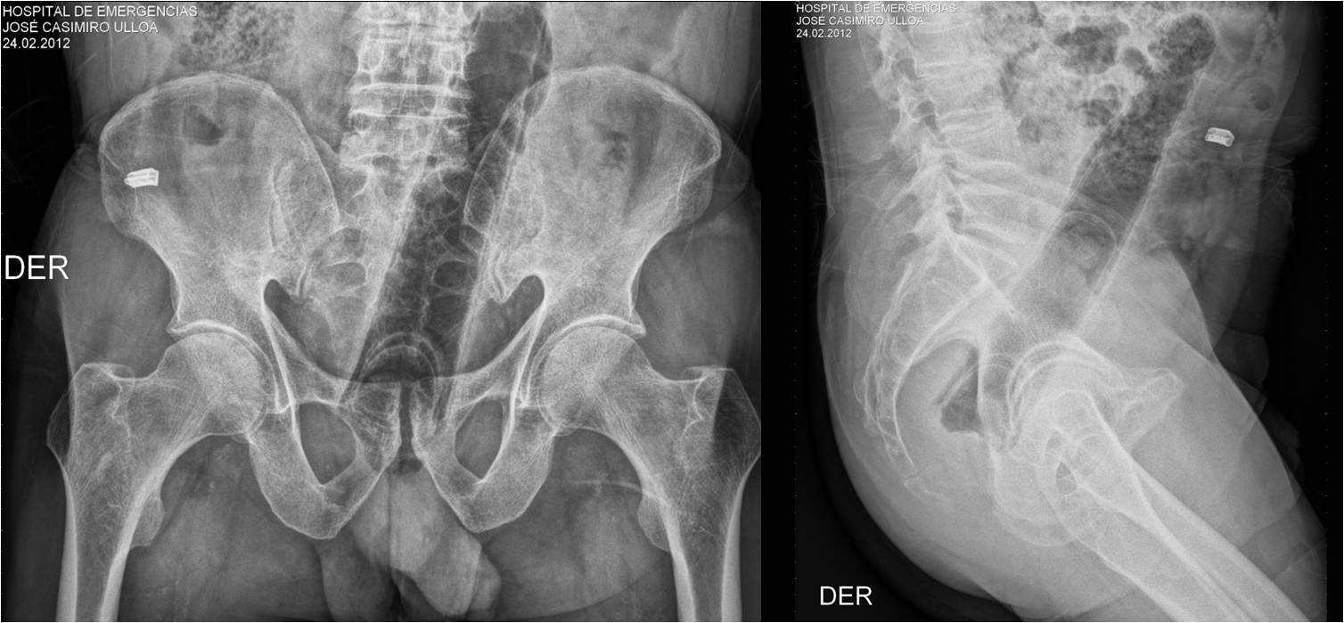 Ap & lat pelvis | Xrays...History & Films | Pinterest