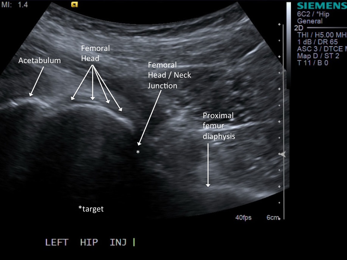 Ultrasound Guided Cortisone Injection