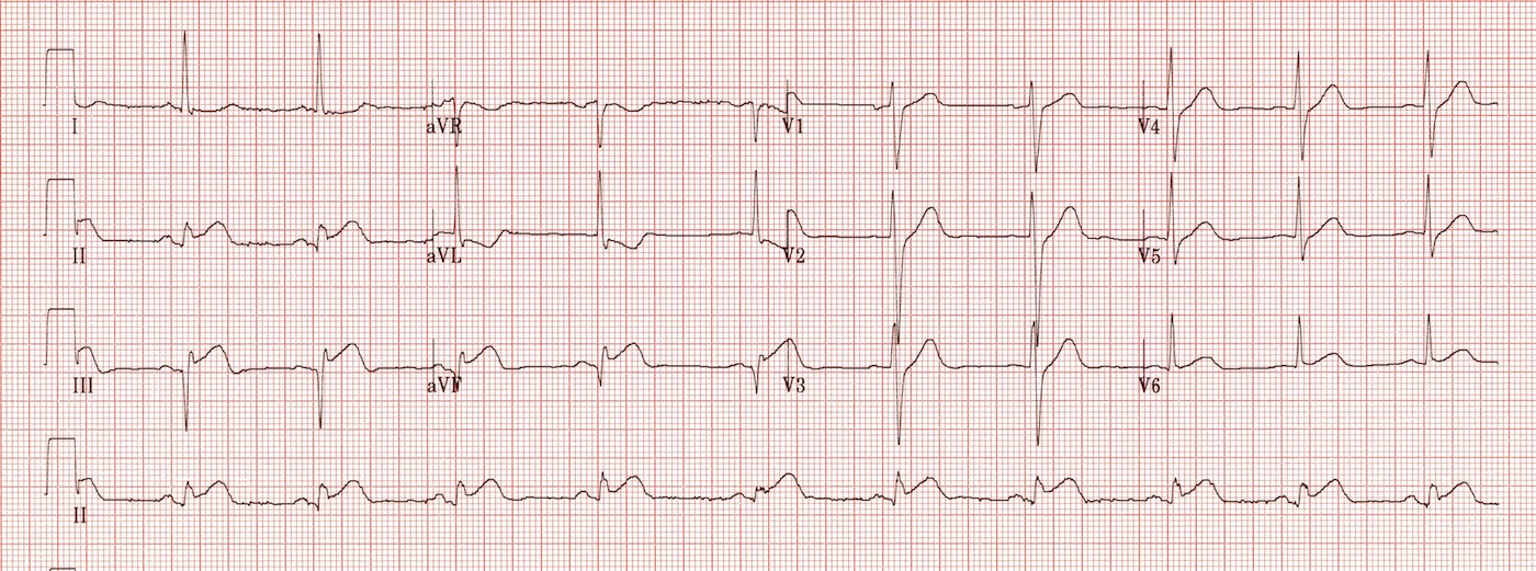 Inferior ST Elevation Myocardial Infarction | INA - ECG