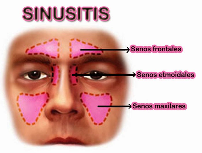 LA SINUSITIS