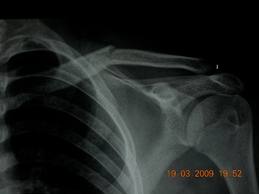 Enfermera en traumatología: Fractura de clavícula