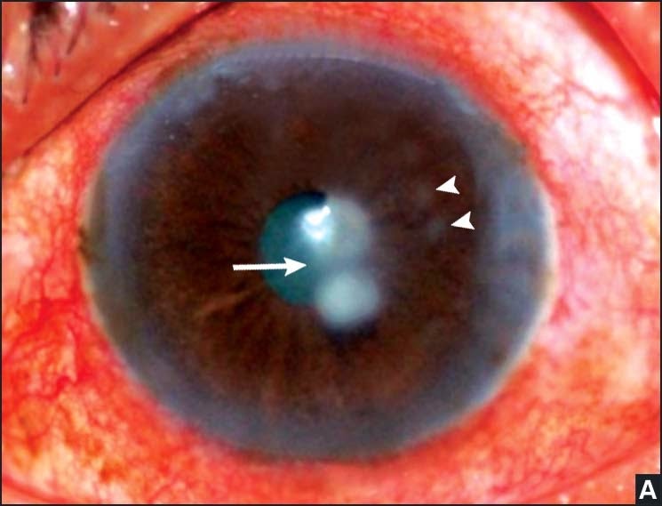 Clinical Presentation of Fungal Keratitis | Tuyenlab