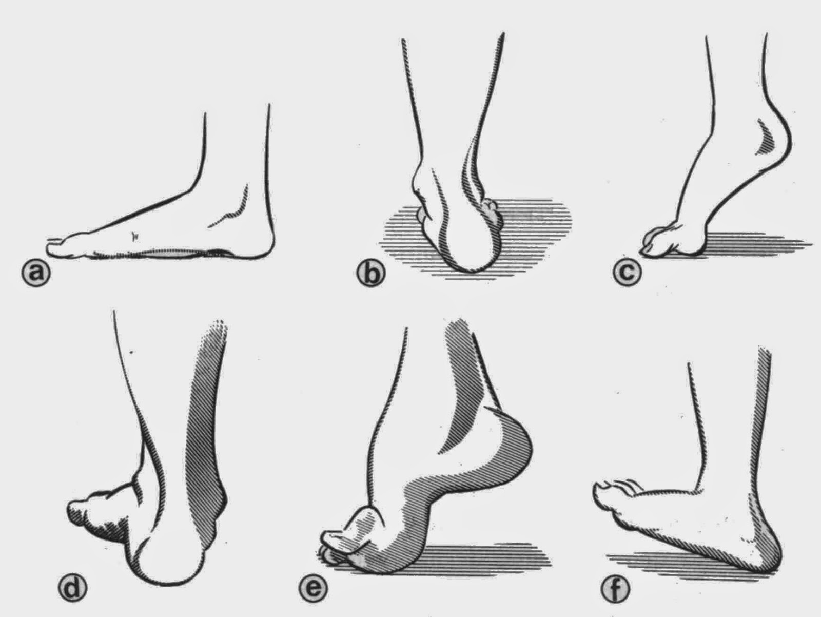 Ci-ortra: PATOLOGIA DEL PIE