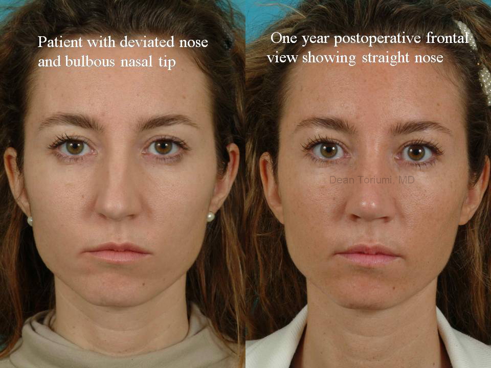 Dr. Dean Toriumi Reviews: Dean Toriumi Reviews: Primary rhinoplasty ...