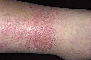 Study Medical Photos: A 45 Year Old Diabetic Man Presents With Leg Swelling