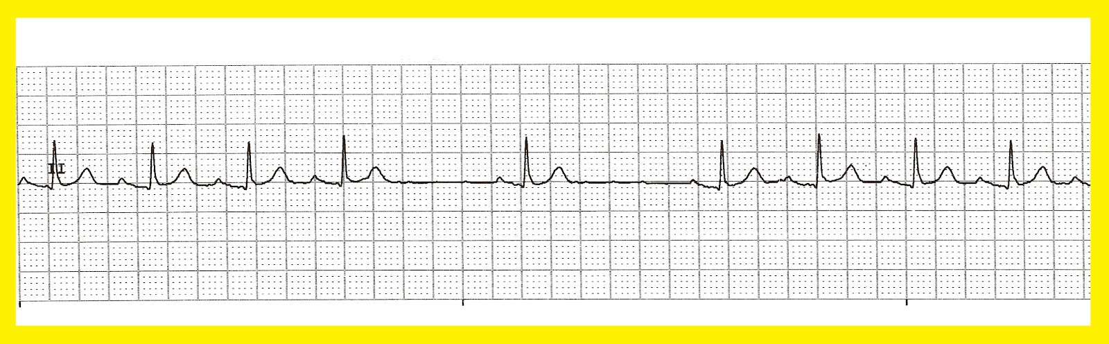 EKG Rhythm Quiz 270