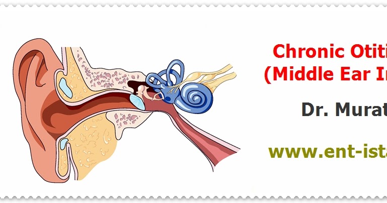 Chronic Otitis Media - Definition, Symptoms, Complications and Treatment
