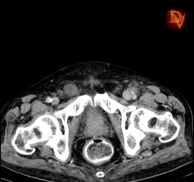 Ultimate Radiology : Urinary Bladder Herniation