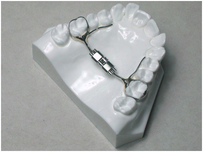 Truman Orthodontics: Unilateral Crossbite With a Functional Shift