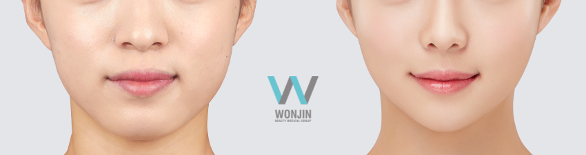 V-lifting, Prosedur Anti-aging yang Dipilih Semua Orang