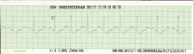 EKG Rhythm Strips 15: Sinus Rhythms