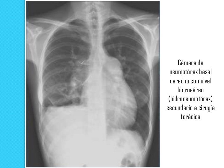 Análisis de placa de torax: BRONQUIOLITIS, BRONCONEUMONÍA Y NEUMOTORAX