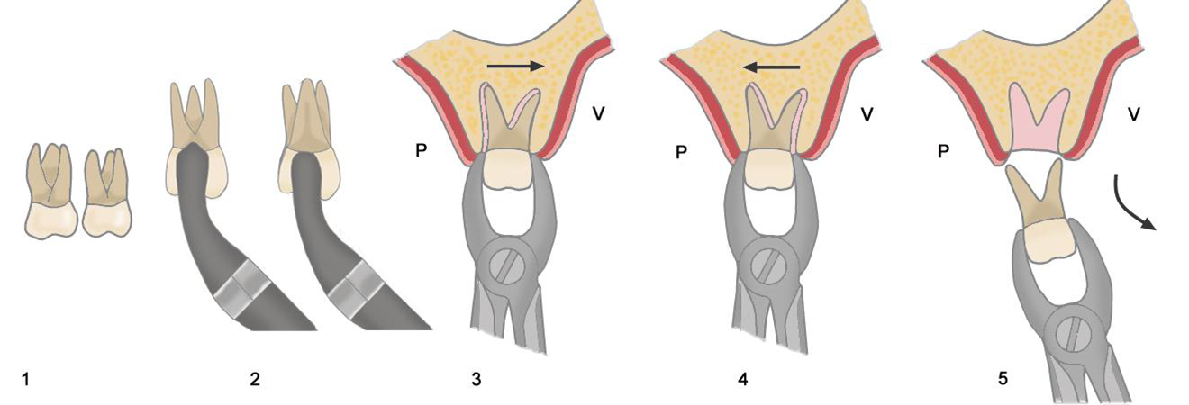 Técnicas de exodoncia.