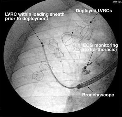 Chest Medicine Made Easy-Dr Deepu: Implanted Coils In Lungs May Benefit ...