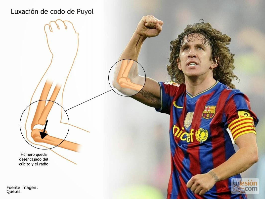 Lesiones de élite: Luxación de codo.