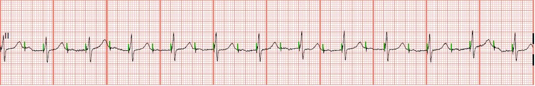 Float Nurse: EKG Rhythm Strip Quiz 59