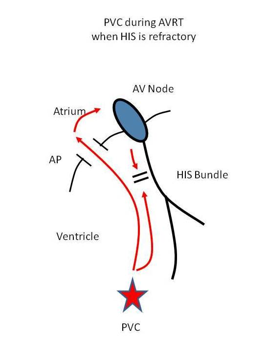 ECG Rhythms: The effect of a spontaneous PVC in a supraventricular ...