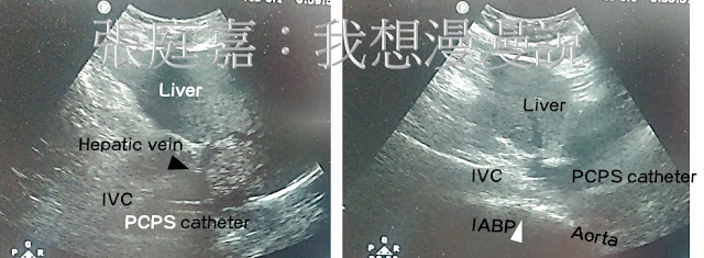 心臟超音波：IVC看甚麼？之一