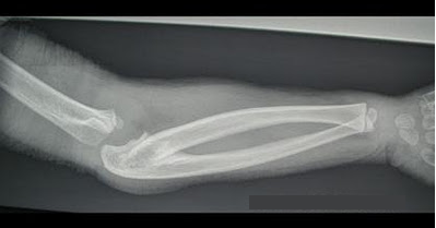 11:50: SINOSTOSIS RADIOCUBITAL CONGÉNITA