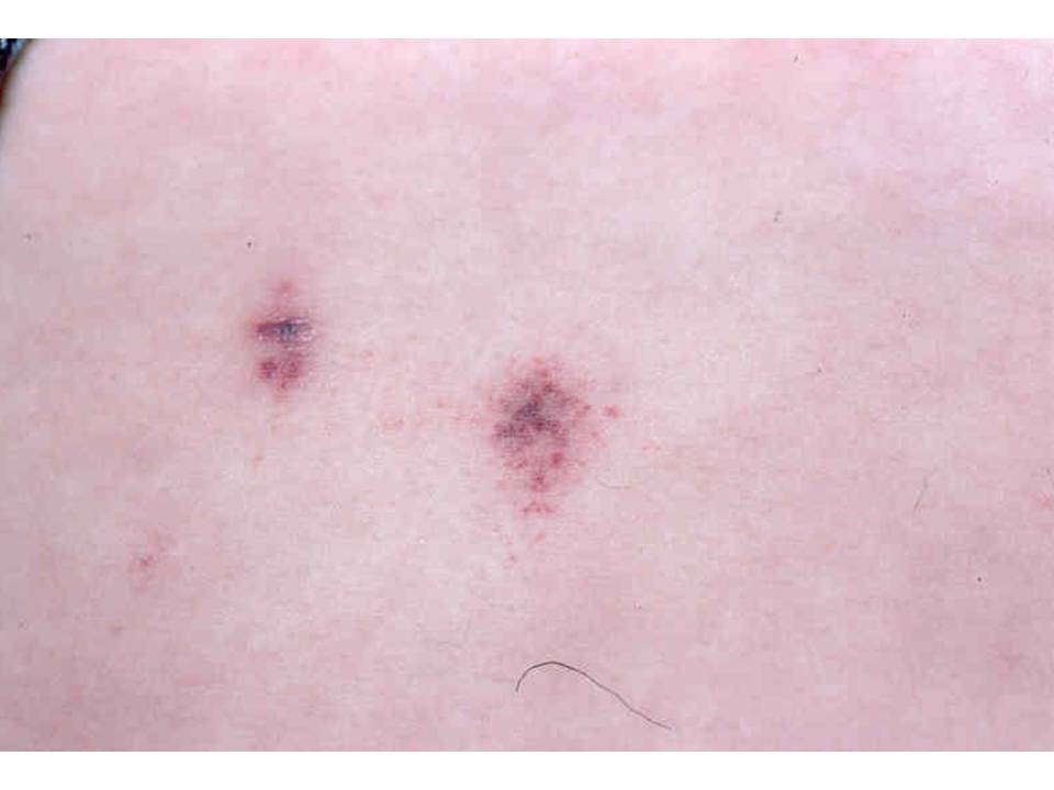 Consultations in Dermatology: Factitial scars - Dermatitis Artefacta