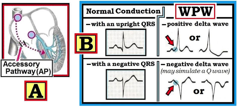 ECG Interpretation: ECG Blog #153 (LVH – RVH – WPW – RBBB)