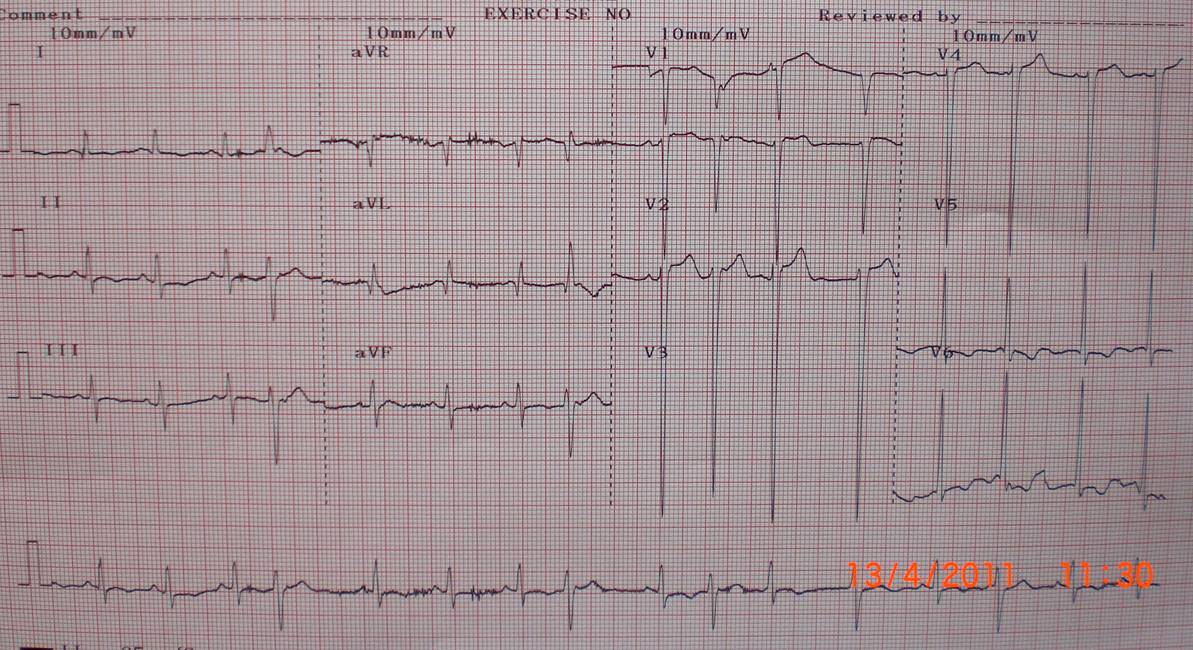 Phimaimedicine: 1,094. EKG dilated cardiomyopathy