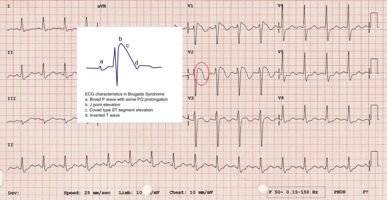 E Learning: ECG bij Syncope: WOBBLER - Acute Zorg Blog
