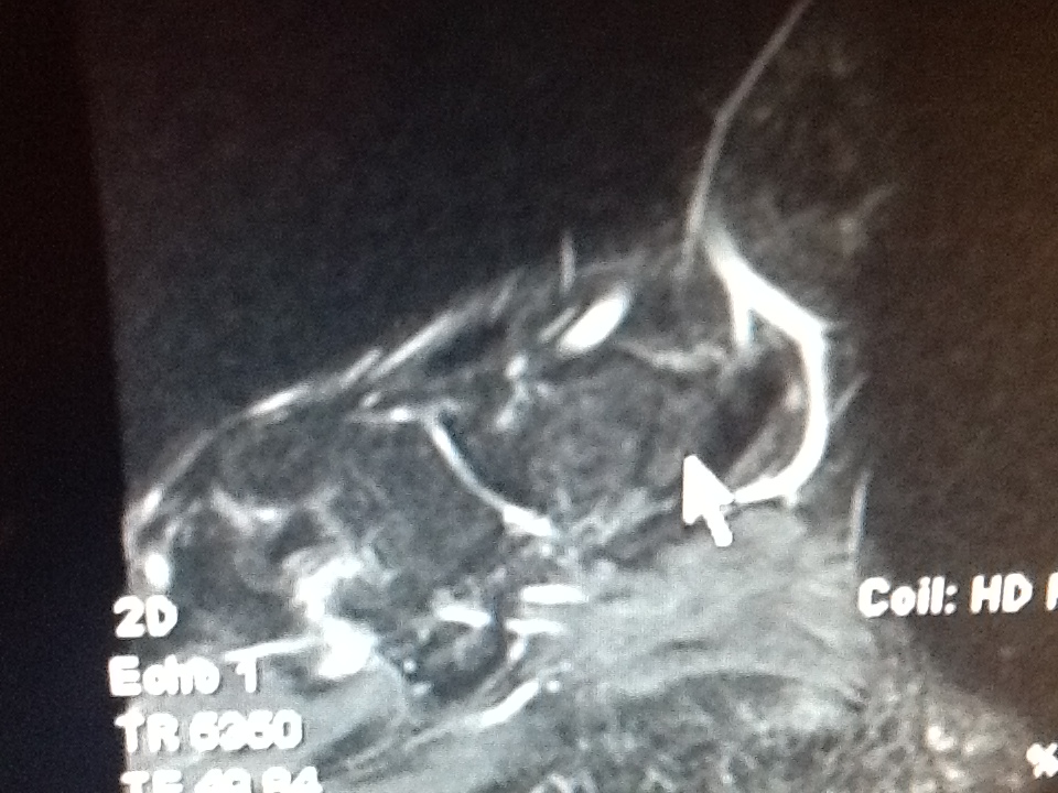Foot and Ankle Problems By Dr. Richard Blake: Images for Os Navicularis ...