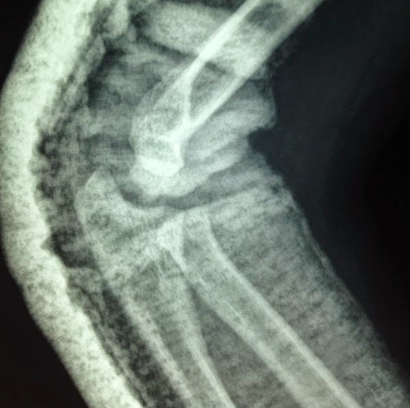 Ortopedia Pediátrica: Discusión entre pares / Fractura de Epitroclea ...
