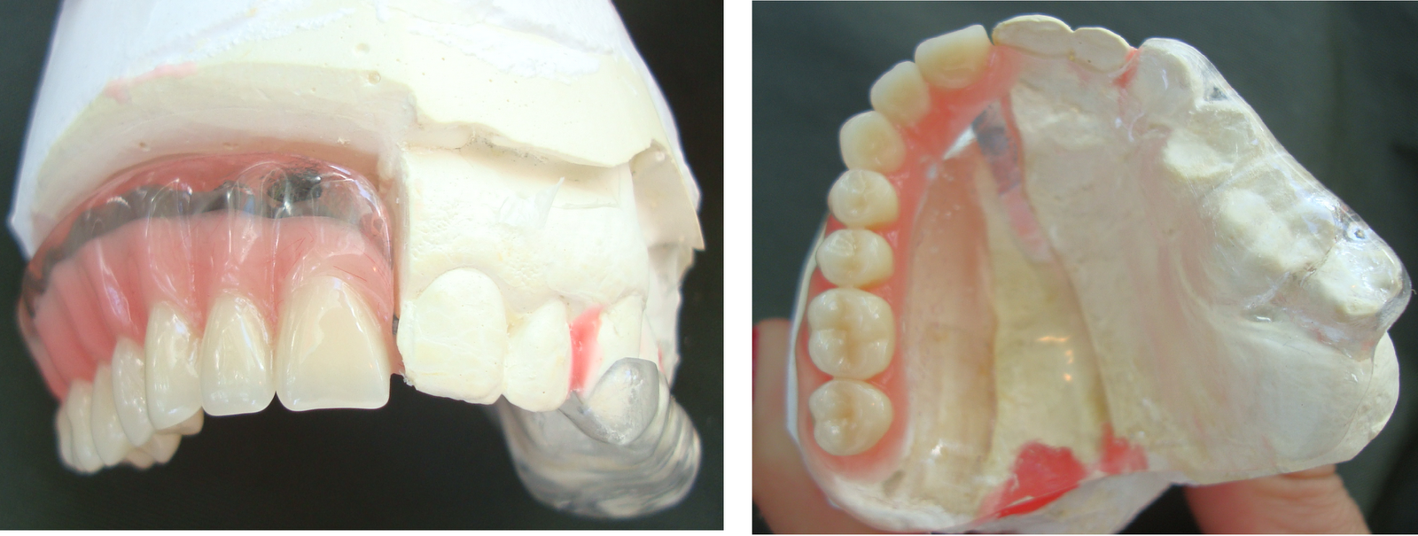 Odontologia Oncológica: Prótese Obturadora de Palato Imediata