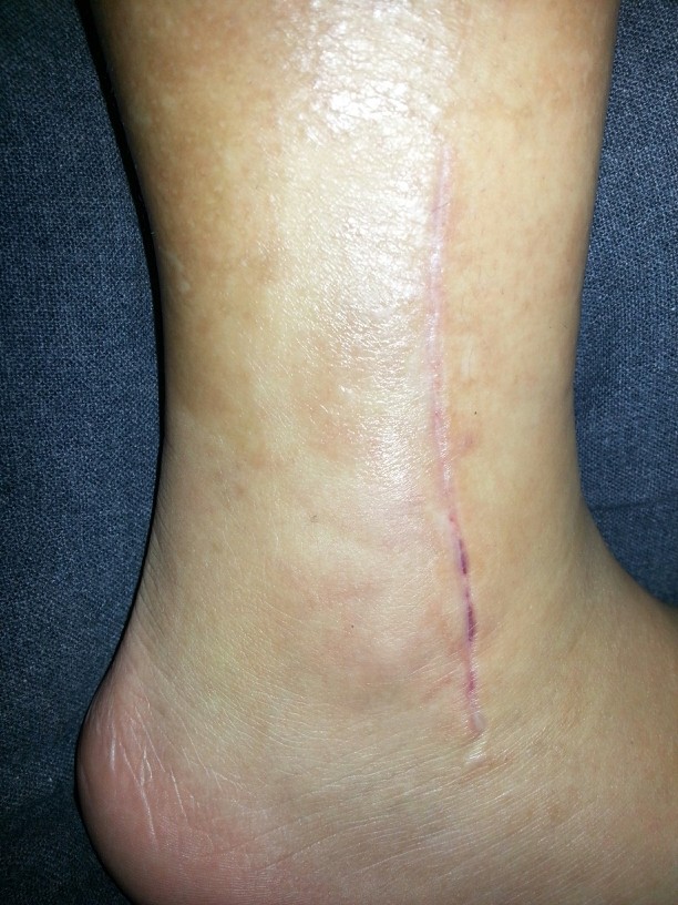 My Broken Ankle =(: Day 16 - Fourth Physical Therapy Session