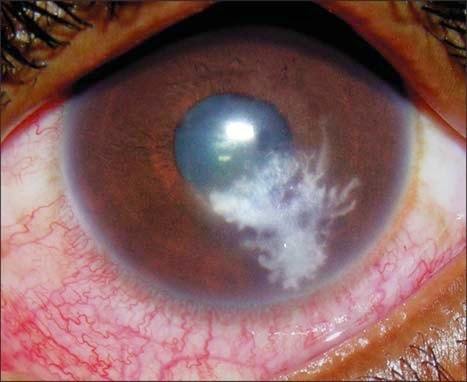 Clinical Presentation of Fungal Keratitis | Tuyenlab