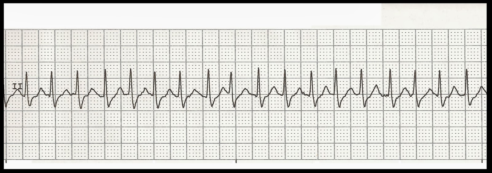 Practice EKG Rhythm Strips 230