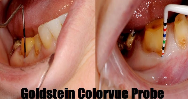 DENTAL INSTRUMENTS: Goldstein Colorvue Probe - Hu-Friedy - Odonto-Tv