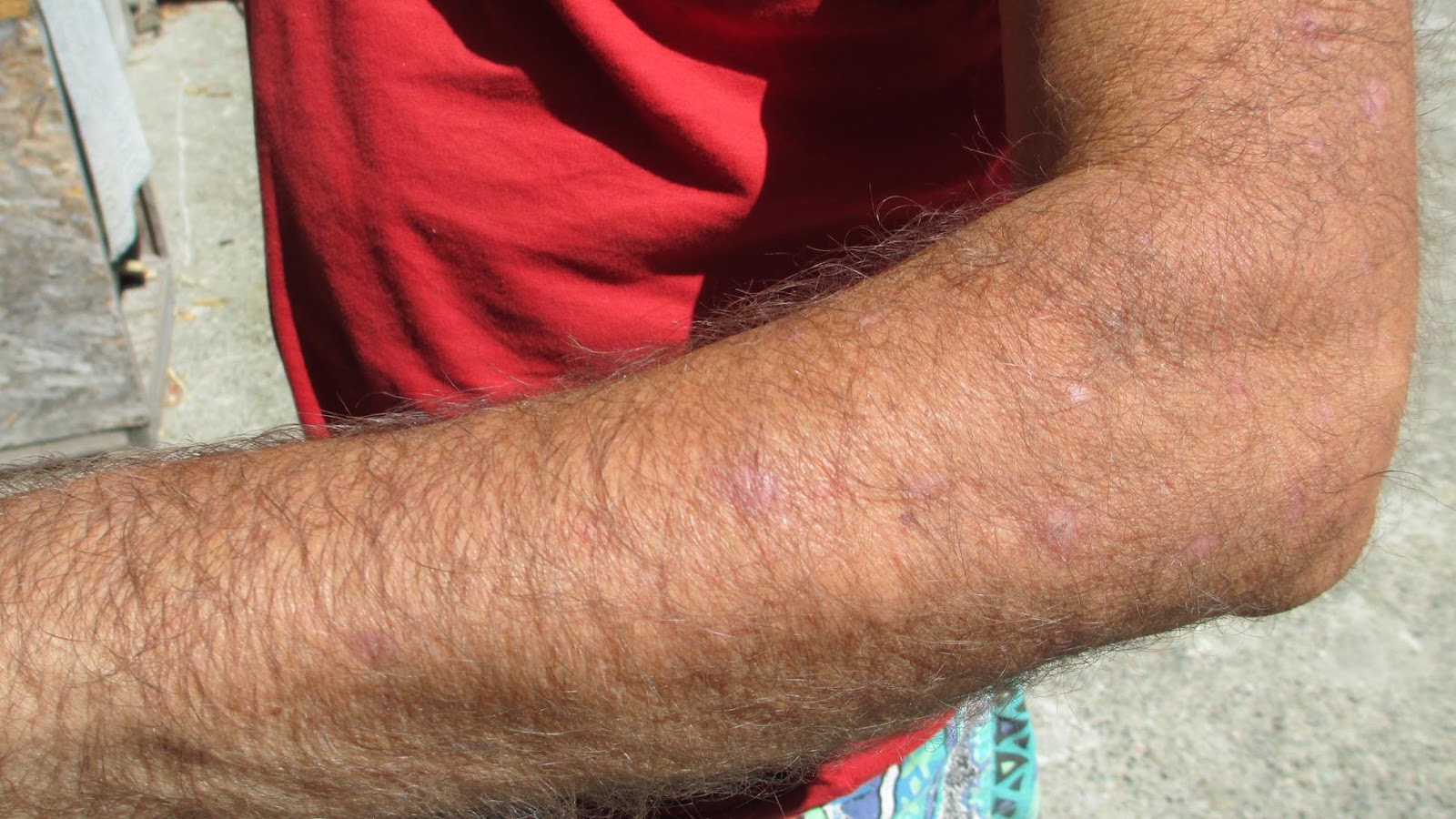 CercoSano per Benessere Globale: 2016 - #Prurito Brachioradiale ( #PBR ...