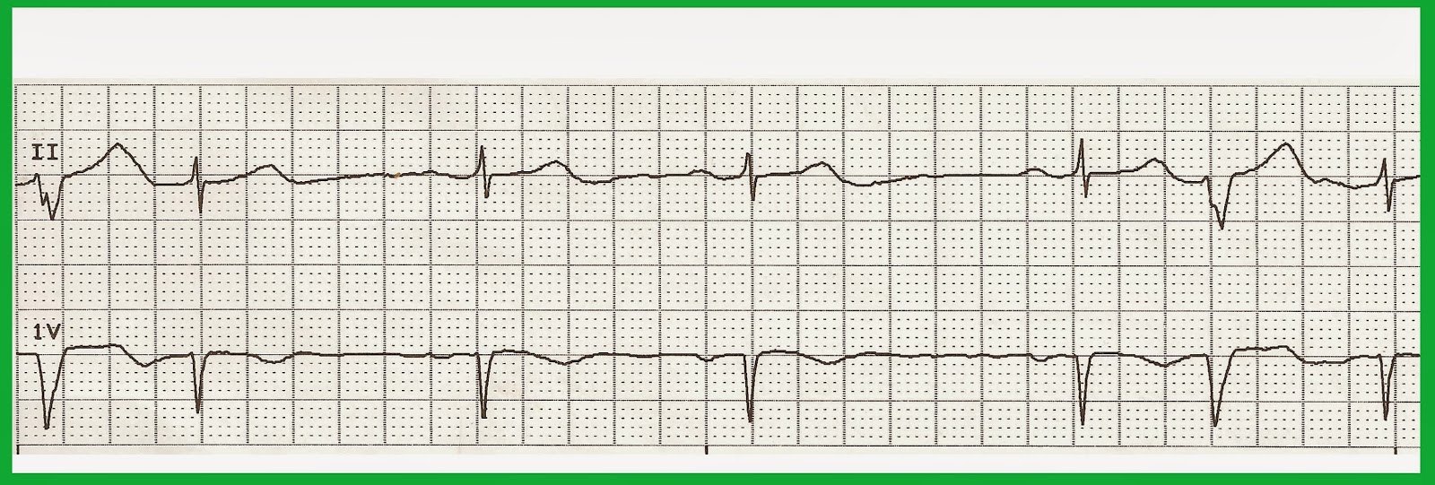 EKG Rhythm Strip Quiz 186