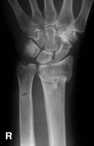 ABC Radiology Blog: Colles’ fracture