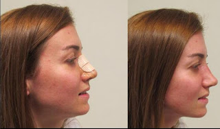 Burun Ameliyatı Önce Sonra Resimleri