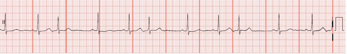 EKG Rhythm Strip Quiz 18