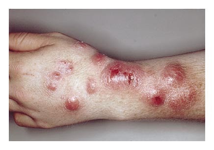 Mycobacterium marinum