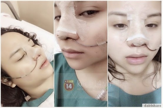 Gadis Vietnam Jadi Popular Di Internert Selepas Lakukan Pembedahan ...