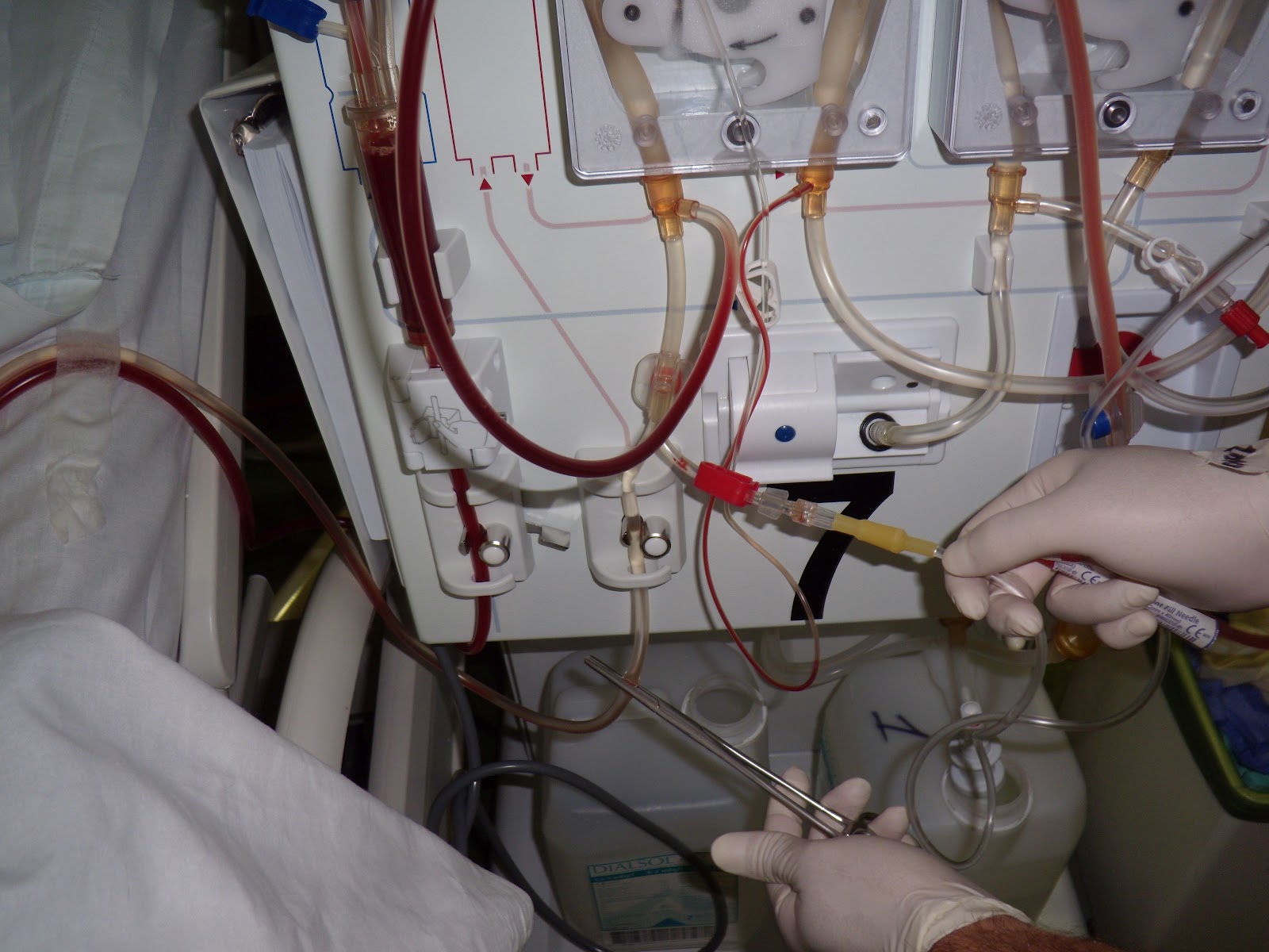 Diálisis, diario para principiantes: Hemodiálisis:Fin y desconexión ...