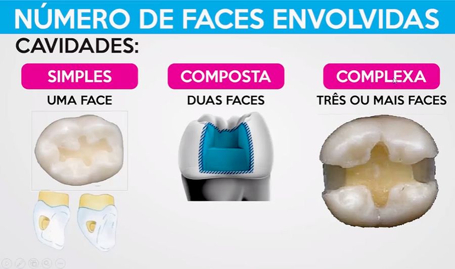 DENTÍSTICA: Cavidades - paredes e ângulos